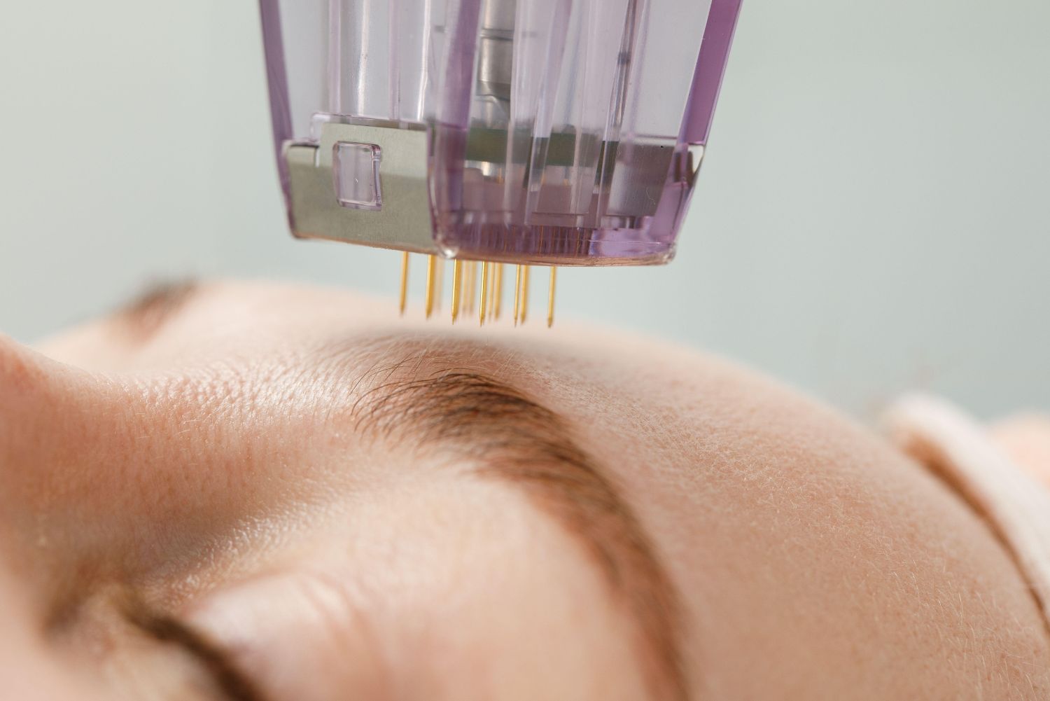 Wat zijn de micro needling nadelen? Alle micro needling op een rij!